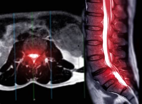 Mri S脊柱或lambar脊柱矢状t2技术诊断脊髓压迫 ——图库图片 © Samunella 656065434