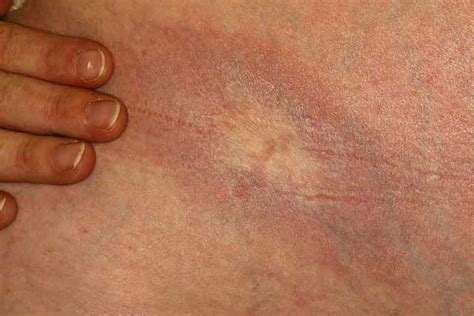 Scleroderma Pictures How Rash Symptoms Look