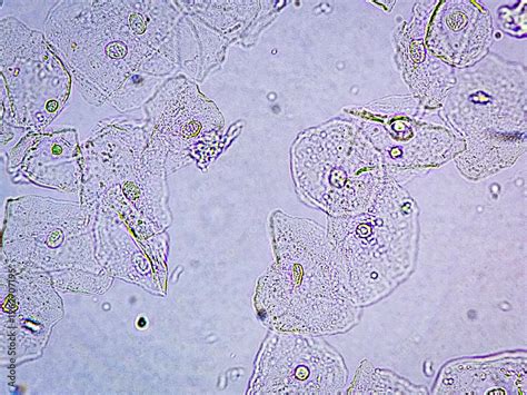 Epithelial Cells With Bacteria In Patient Urine Urinary Tract Infections Analyze By