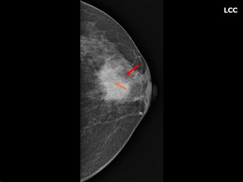 Examples Of Benign Left And Malignant Right Masses In Mammograms