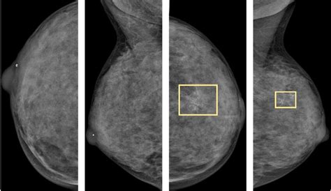 Example Breast Mammogram Images With Calcification And A Mass