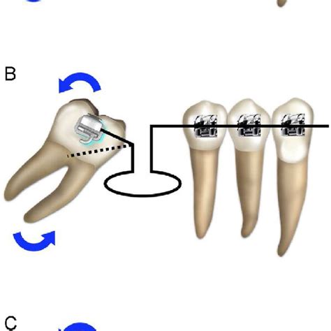 Force System For Mandibular Second Molar Uprighting A The Download Scientific Diagram
