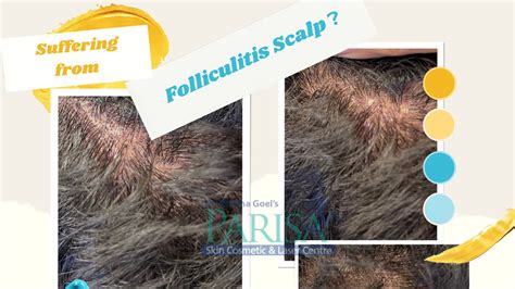 Folliculitis Scalp