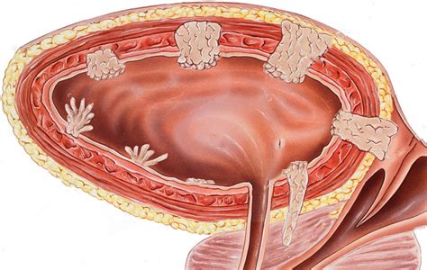 Diagnosis Of Bladder Cancer Dr Nader Awad Port Macquarie