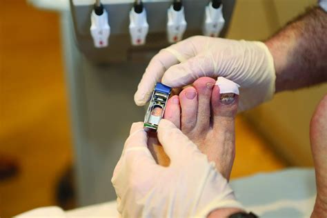 Dermatophyte Testing Service In Amersham Bucks Area Bucksfoot Clinic