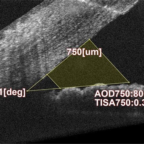 The Angle Parameters Measured By As Oct Anterior Chamber Angle Aca Download Scientific