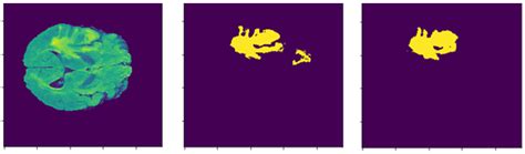 Attention 3d U Net With Multiple Skip Connections For Segmentation Of Brain Tumor Images