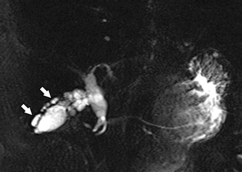 Gallbladder Carcinoma And Its Differential Diagnosis At Mri What
