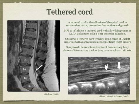 Mri And X Ray Of The Neonate Spine