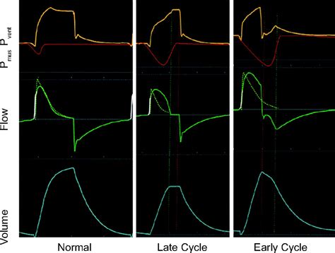 A Taxonomy For Patient Ventilator Interactions And A Method To Read Ventilator Waveforms A Taxonomy For Patient Ventilator Interactions And A Method To Read Ventilator Waveforms