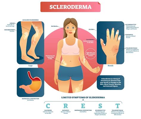 Sclerodermia Cosè Sclerosi Sistemica Sintomi Cause E Cura