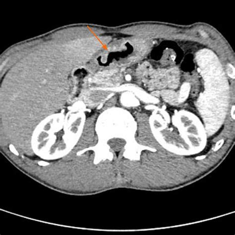 Findings From Preoperative Abdominal Computed Tomography Abdominal