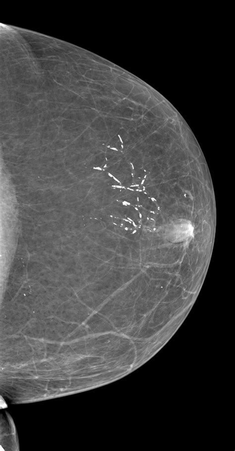 Segmental Breast Calcifications Ajr
