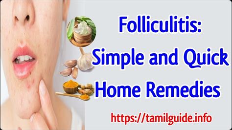 Folliculitis Simple And Quick Home Remedies Youtube