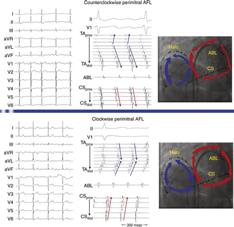 Macroreentrant Atrial Tachycardia “atypical Atrial Flutter