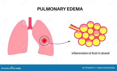 Pulmonary Edema Disease Cartoon Vector 273622815
