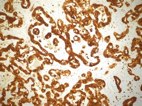 A Diffuse S100p Expression In A Large Duct Intrahepatic Download