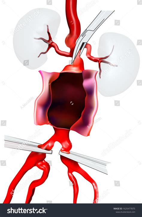 Abdominal Aortic Aneurysm Repair