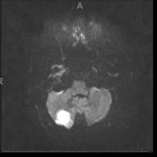The Diffusion Weighted Imaging Demonstrates A 1 5 Cm Area Of Restricted Download Scientific