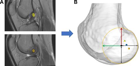 Do Sex Specific Differences Exist In ACL Attachment Location An MRI Based Dimensional
