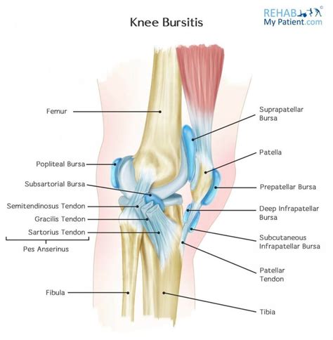 Knee Bursitis Rehab My Patient Bursitis Knee Bursitis Swollen Knee