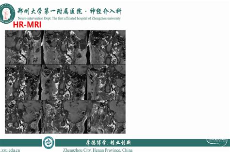 右侧椎动脉v4段狭窄支架置入术