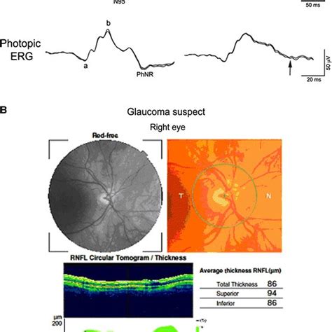 Ganglion Cell Loss In Early Glaucoma As Assessed By Photopic Negative