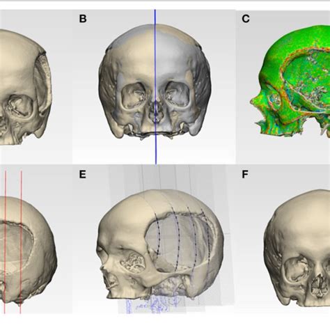 Schematic Representation Of Steps Involved In The Anatomical Design