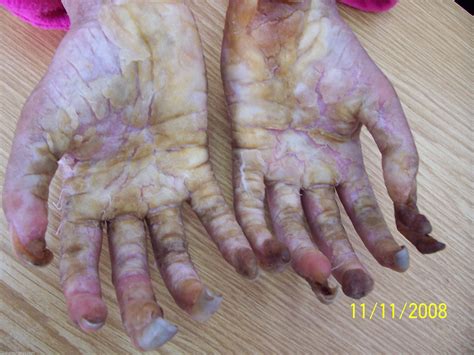 Global Skin Atlas Diagnosis Detail