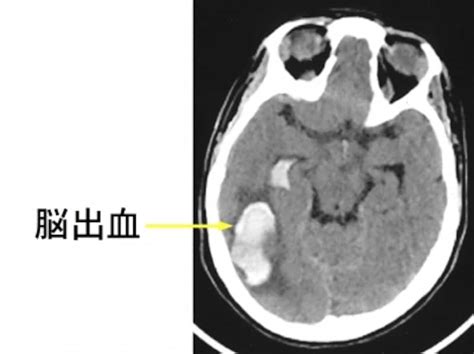 もやもや病の症状診断治療 脳神経の病気 All About
