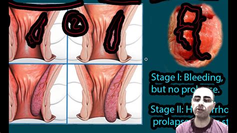 Stage 1 Hemorrhoids