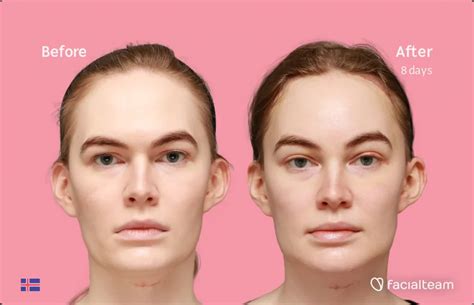 Helga Before And After Ffs Surgery — Facialteam