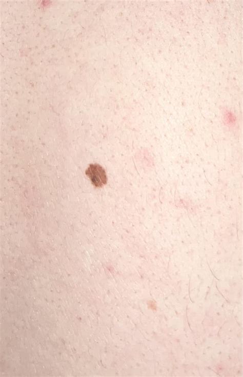 Mole Concerned Rmelanoma