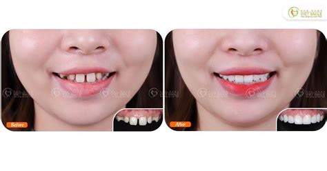 Ghim Trên Bọc Răng Sứ Nha Khoa Việt Smile