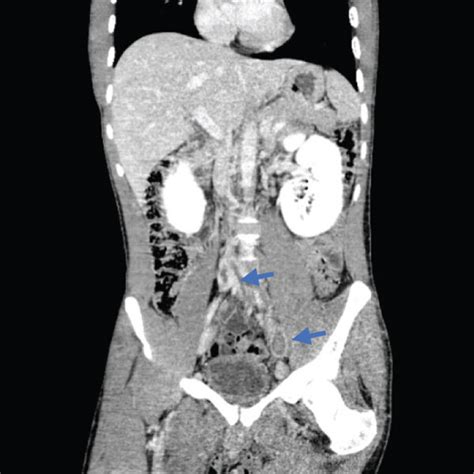 A B C Ct Abdomenpelvis With Contrast Significant For Occlusive Download Scientific Diagram