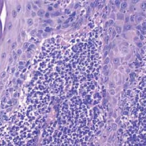 Dense Predominantly Plasmocytic Infiltrate Throughout The Entire