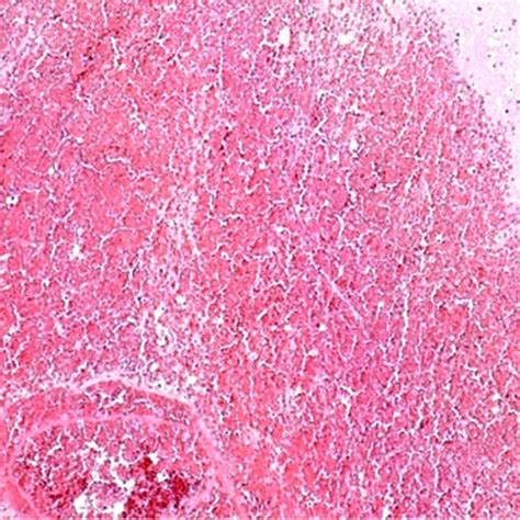 Intraparenchymal Hematoma Hematoxylineosin He Staining ×100