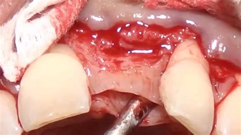 Soft Tissue Augmentation Before Implant Installation The Connective Tissue Platform Technique