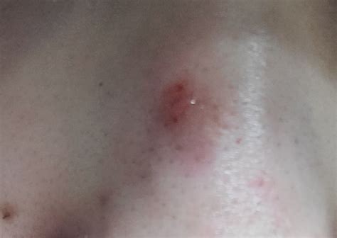 코에 여드름 썩었을때 어떡하죠 지식in