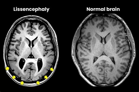 Lissencephaly Pictures Lissencephalies Medlink Neurology