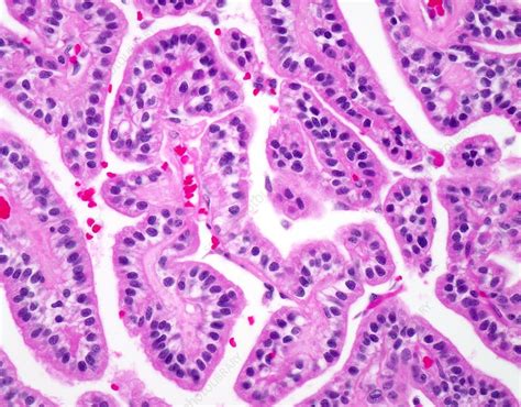 Choroid Plexus Papilloma Light Micrograph Stock Image C0499236 Choroid Plexus Papilloma Light Micrograph Stock Image C0499236