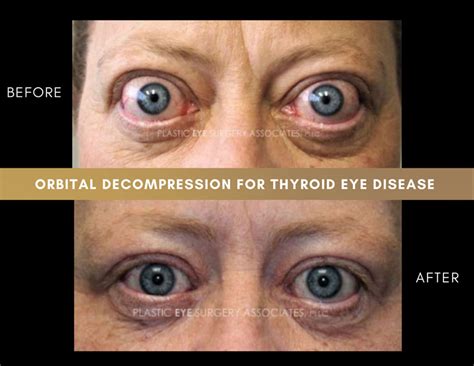 Graves Disease Eyes Bulging