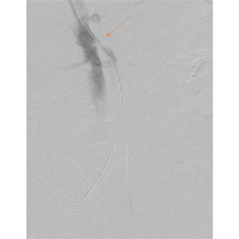 Mesenteric Angiogram Demonstrating Stenosis Of The Superior Mesenteric Download Scientific