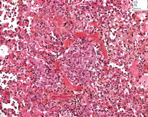Necrotizing Bronchiolitis Human Pathology