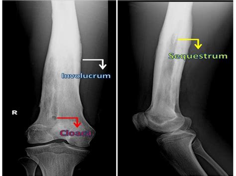 Sequestrum And Its Types