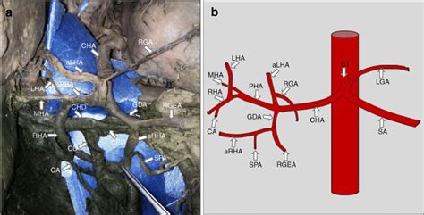 Rare Combined Variations Of Accessory Left Hepatic Artery And Accessory Download Scientific