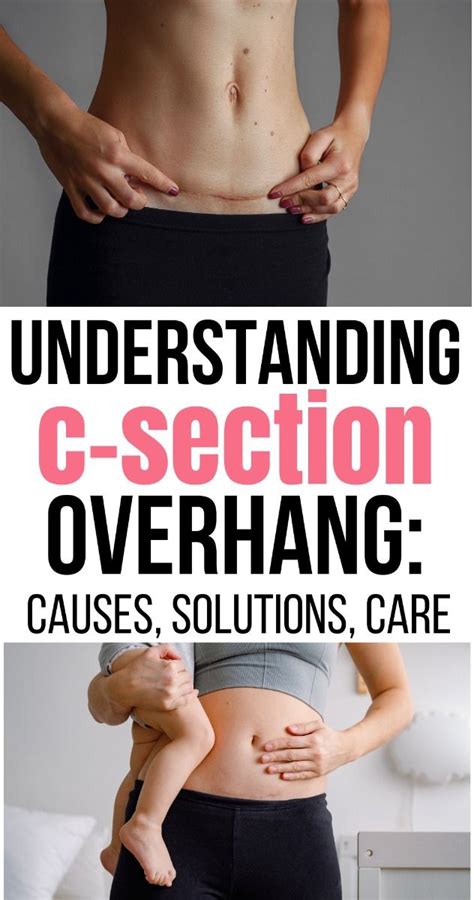 Understanding C Section Overhang Everything You Need To Know Pregnancy Workout C Section