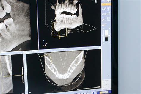 Can Braces Fix Jaw Alignment