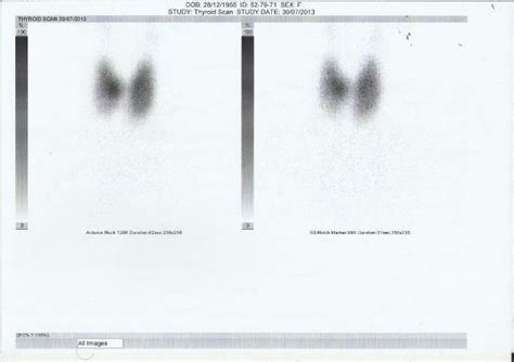 Study Of Thyroid Scan Of Patient 11 With Id 52 79 71 Sex F Download
