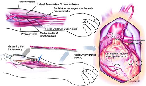 Ardianas Coronary Artery Bypass Graft Cabg